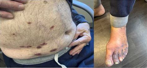 Kaposi Sarcoma In An Individual Recently Diagnosed With Hiv Pmc