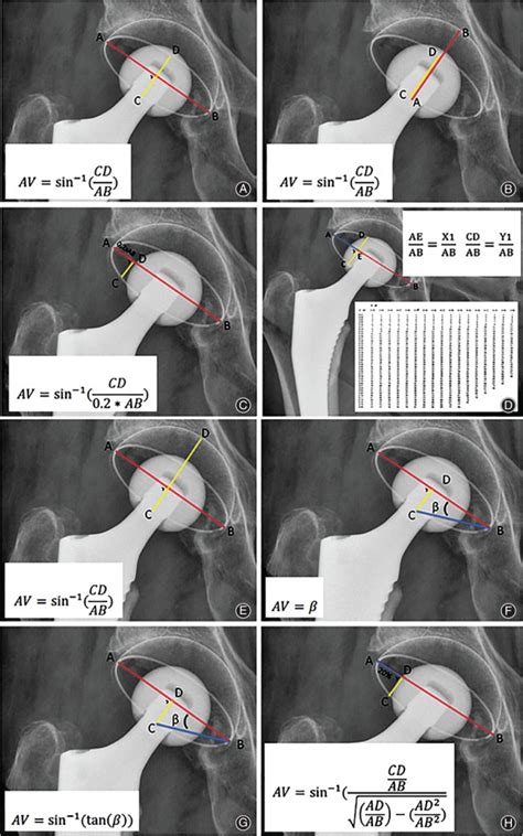 Non‐equivalent Results From Different Anteversion Measurements Methods For The Evaluation Of The