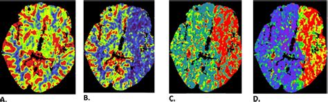 Postoperative Computed Tomography Perfusion Imaging Showing A Large Download Scientific Diagram