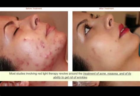 Michelle Perrone Francis Bsn Rn On Linkedin Red Light Therapy Is A Healing Light Developed By