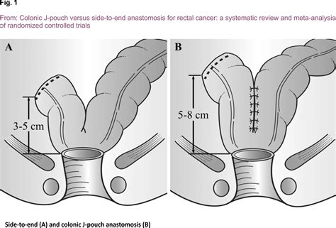 Colonic J Pouch Versus Side To End Anastomosis For Rectal Cancer A
