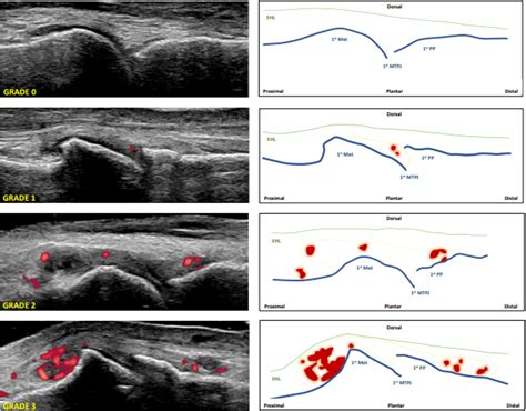 Development Of An Ultrasound Imaging Atlas For Grading Osteoarthritis