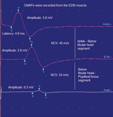 Neuropathic Pain In Peroneal Nerve Entrapment At The Fibular Head