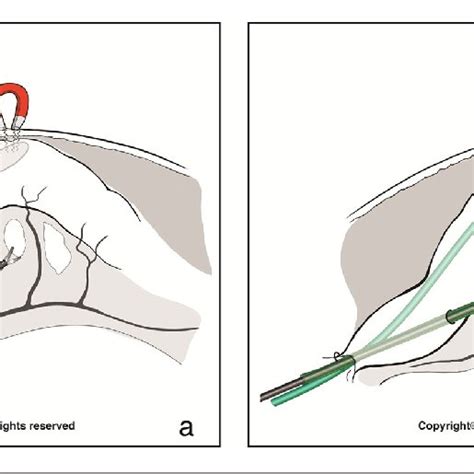 Sigmoid Colon Mesentery Dissection Instruments Are Passed Through The