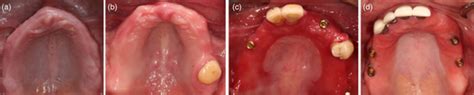 Denture Stomatitis—an Interdisciplinary Clinical Review Mcreynolds