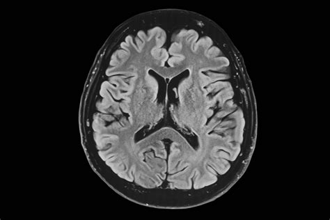 Brain Scan Schizophrenia