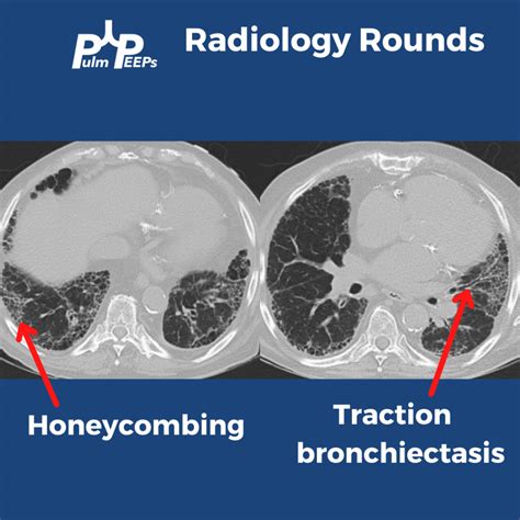 Radiology Rounds 61422 Pulmpeeps