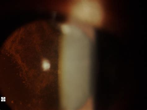 Sonoran Desert Eye Center Posterior Subcapsular Cataract