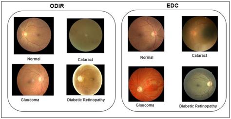 Artificial Intelligence Driven Eye Disease Classification Model
