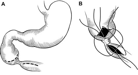 Figure 5 From Neonatal Bowel Obstruction Semantic Scholar