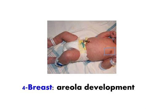 Neonatal Gestational Age Assessmentppt