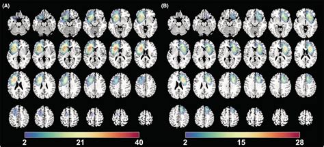 The Overlapping Results Of Prefrontal Lobe Gliomas The Overlapping Download Scientific Diagram