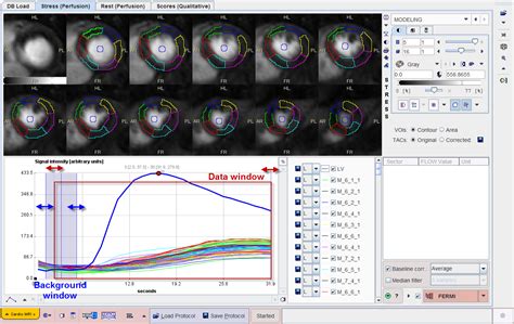 Cardiac Perfusion Data Processing Perfusion Calculation
