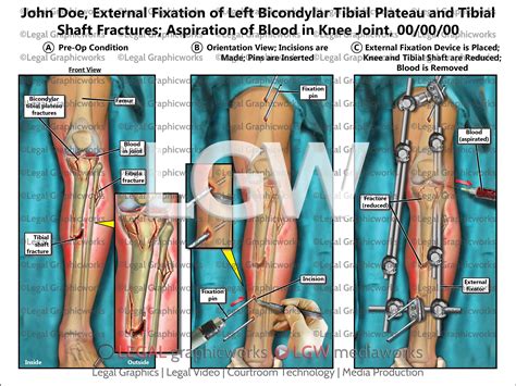 External Fixation Of Left Bicondylar Tibial Plateau And Tibial Shaft F