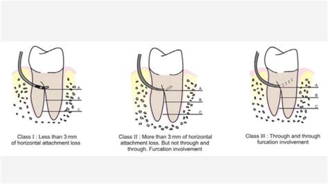 Furcation Involvement Periodontology 2 Pptx