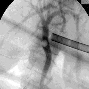 A Numerous CBD Stones And B Single CBD Stone By IOC Download Scientific Diagram