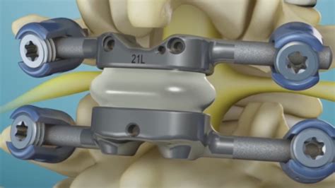 Novel Tops Back Surgery Now Available In Colorado Fox31 Denver