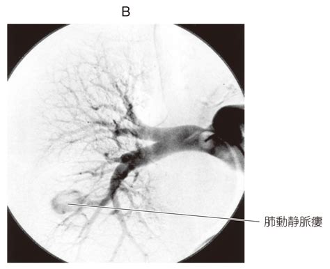 99a14 肺動静脈廔 国試 M3e Medical