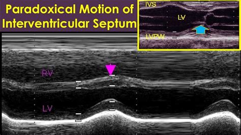 What Is Paradoxical Motion Of Interventricular Septum Youtube