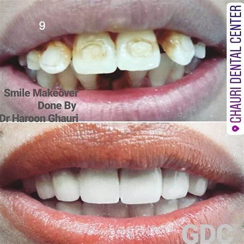 Smile Makeover Haroon Ghauri Prosthocontest2019