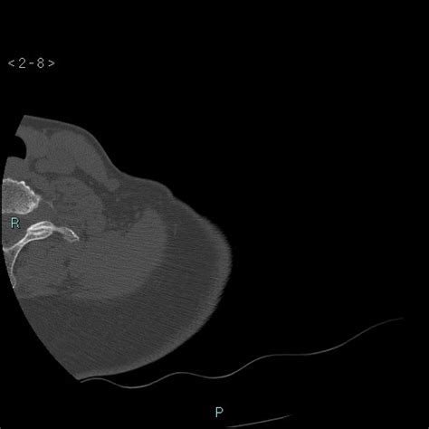 Avascular Necrosis Of The Shoulder Cruess Stage I Radiopaedia 77674