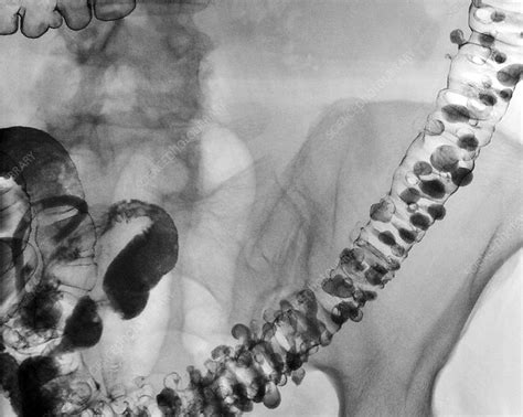 Diverticulitis X Ray Stock Image C0194457 Science Photo Library