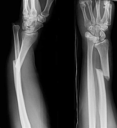 Displaced Fracture With Dislocation