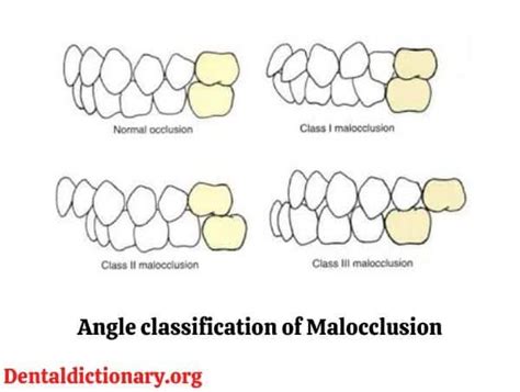 Angle Classification Of Malocclusion Dental Dictionary