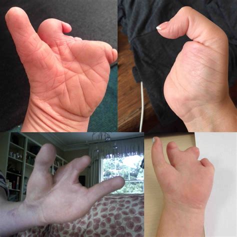 Limb Difference Aid The Active Hands Company