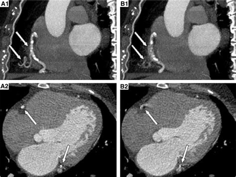 Impact Of A Motion Correction Algorithm On Image Quality In Patients