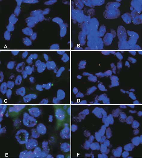 Figure 1 From Molecular Detection Of Fgfr2 Rearrangements In Resected Intrahepatic