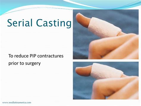 Ppt Therapy Considerations For The Ulnar Nerve Powerpoint
