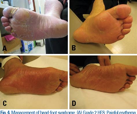 Hand Foot Syndrome Post Chemotherapy At Guadalupe Wolf Blog