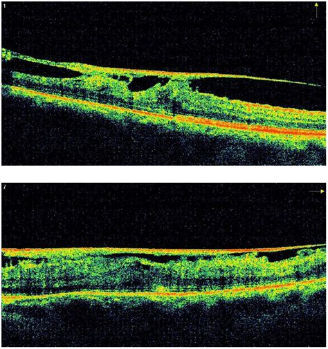 OCT Scan Of The Same Lesion Shown In Fig 5 Demonstrating A Download Scientific Diagram