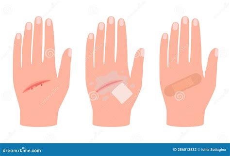 Wound Of Hand Human Skin Scratch First Aid For Cut Injury Skin