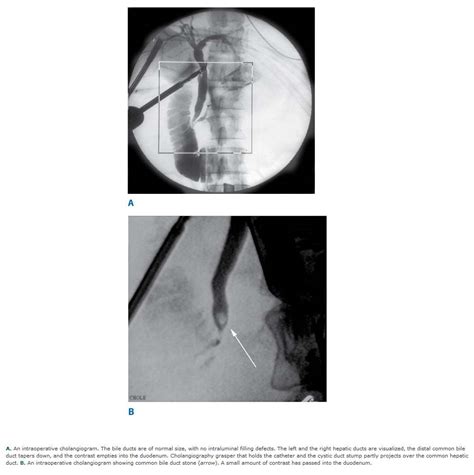 Intraoperative Cholangiography Bedahunmuhs Blog