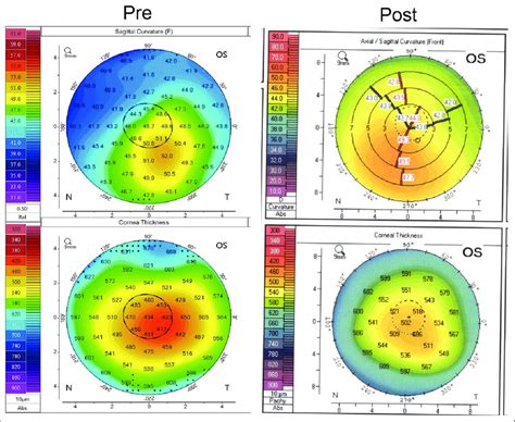 Figure Bb Case 1 Total Corneal Refractive Power And Corneal Thickness