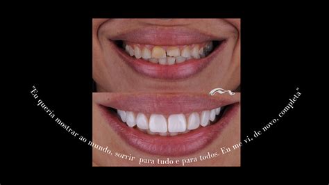 Facetas Em Resina Para Bruxismo