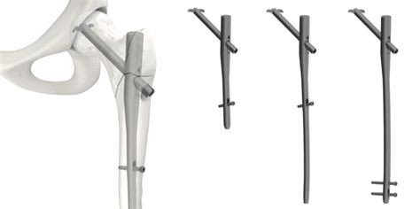 Hansson Dc Nail System® Twin Hook Solutions Fixation Products Medhold