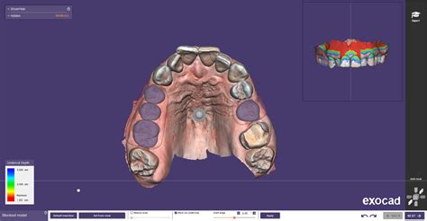 Partial Framework Design Exocad
