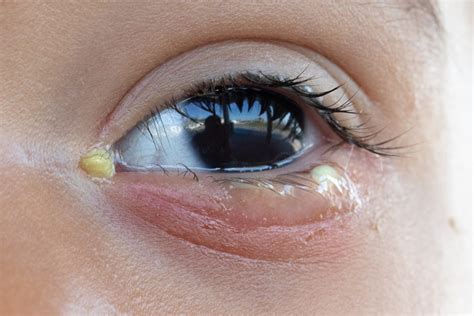 The Common Cause Of A Sticky Eye In The Morning Eyecare Network