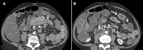 Ulcerative Jejunoileitis In Cs Axial Cte Images A B Showing Decreased