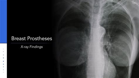 Breast Implants Chest X Ray Findings Youtube