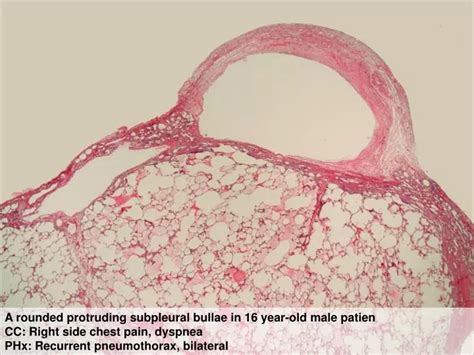 PPT Thick Pleural Fibrosis Due To Repeated Air Leakage And Inflammaion PowerPoint Presentation