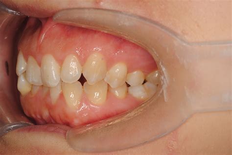 Aligner Treatment Clinical Cases Acura Aligner Solutions