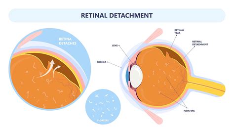 What Is A Retinal Tear In The Eye