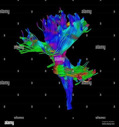 White Matter Fibres Coloured 3d Diffusion Tensor Imaging Dti Scan Of The Bundles Of White