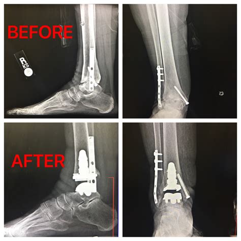 Reverse Ankle Surgery