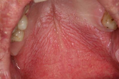 Bumps On Roof Of Mouth