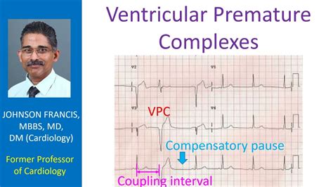 Premature Ventricular Complex